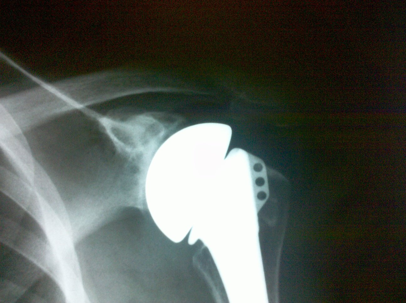 Hemiarthroplasty of the Shoulder : Wheeless' Textbook of Orthopaedics
