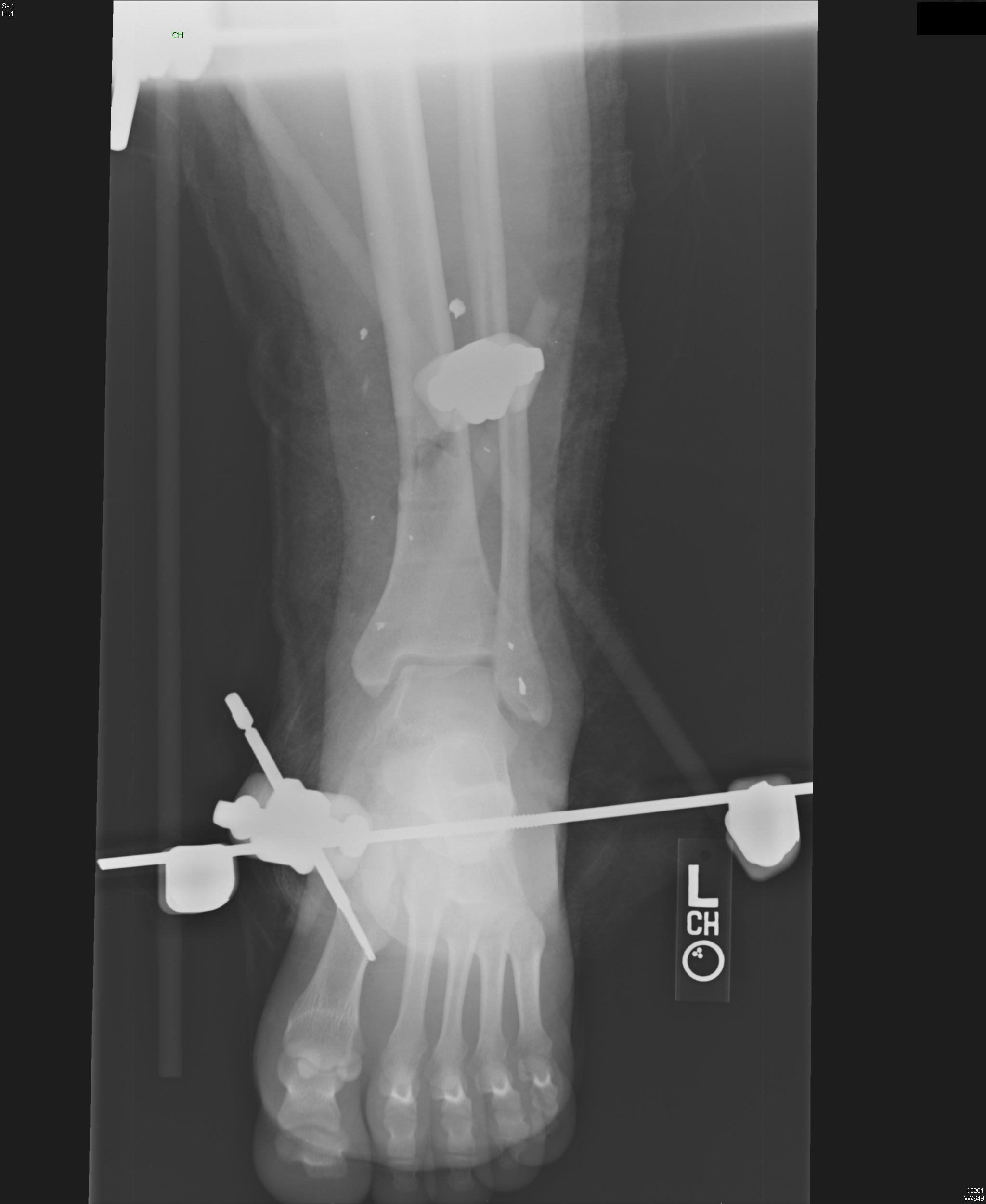 IV. Extremity Fractures in an Austere Environment : Wheeless' Textbook ...