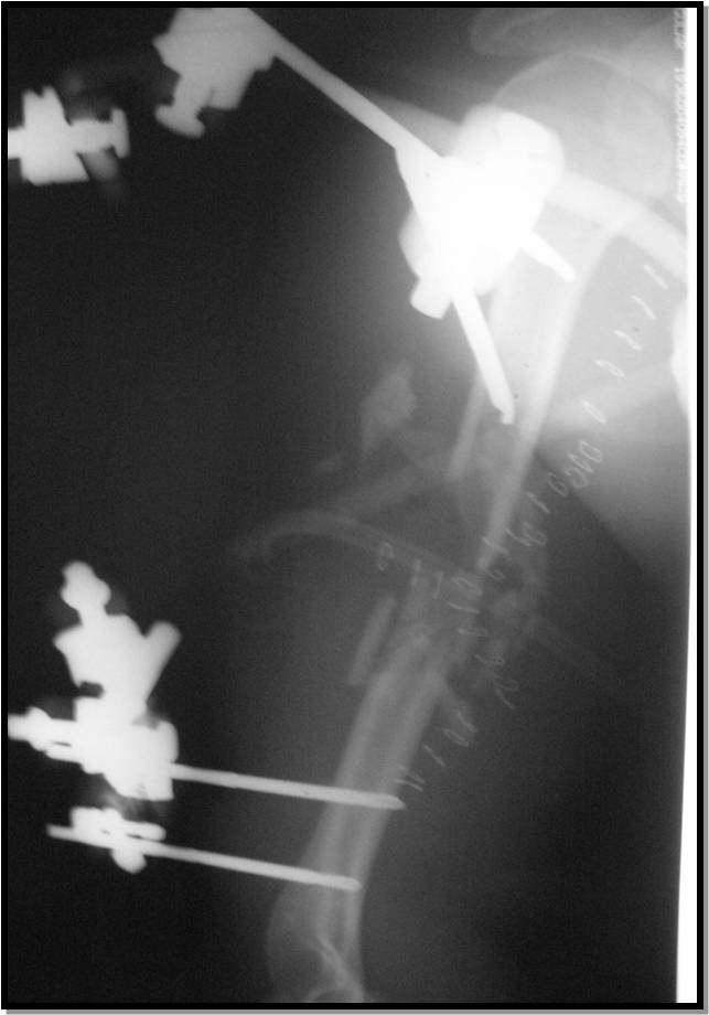 IV. Extremity Fractures in an Austere Environment : Wheeless' Textbook ...