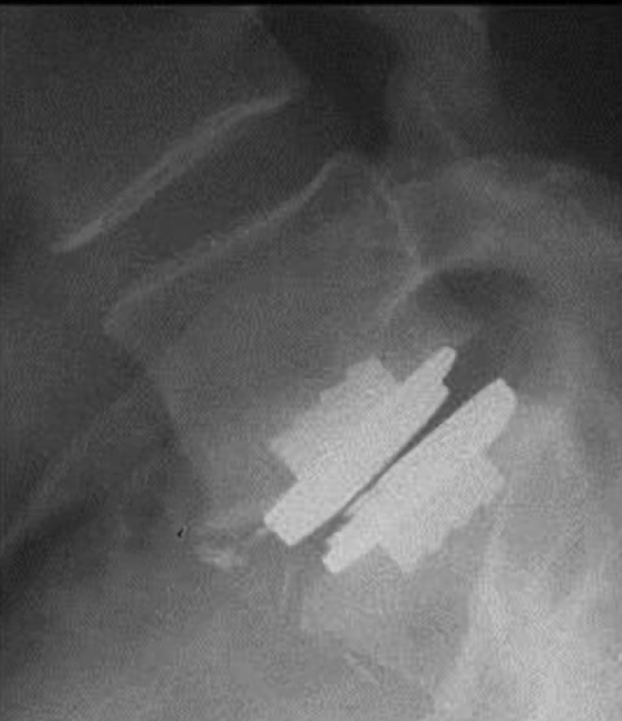 Lumbar Total Disc Replacement : Wheeless' Textbook of Orthopaedics